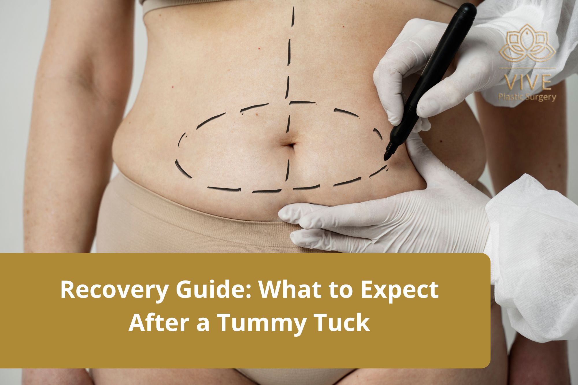 Recovery Guide: What to Expect After a Tummy Tuck