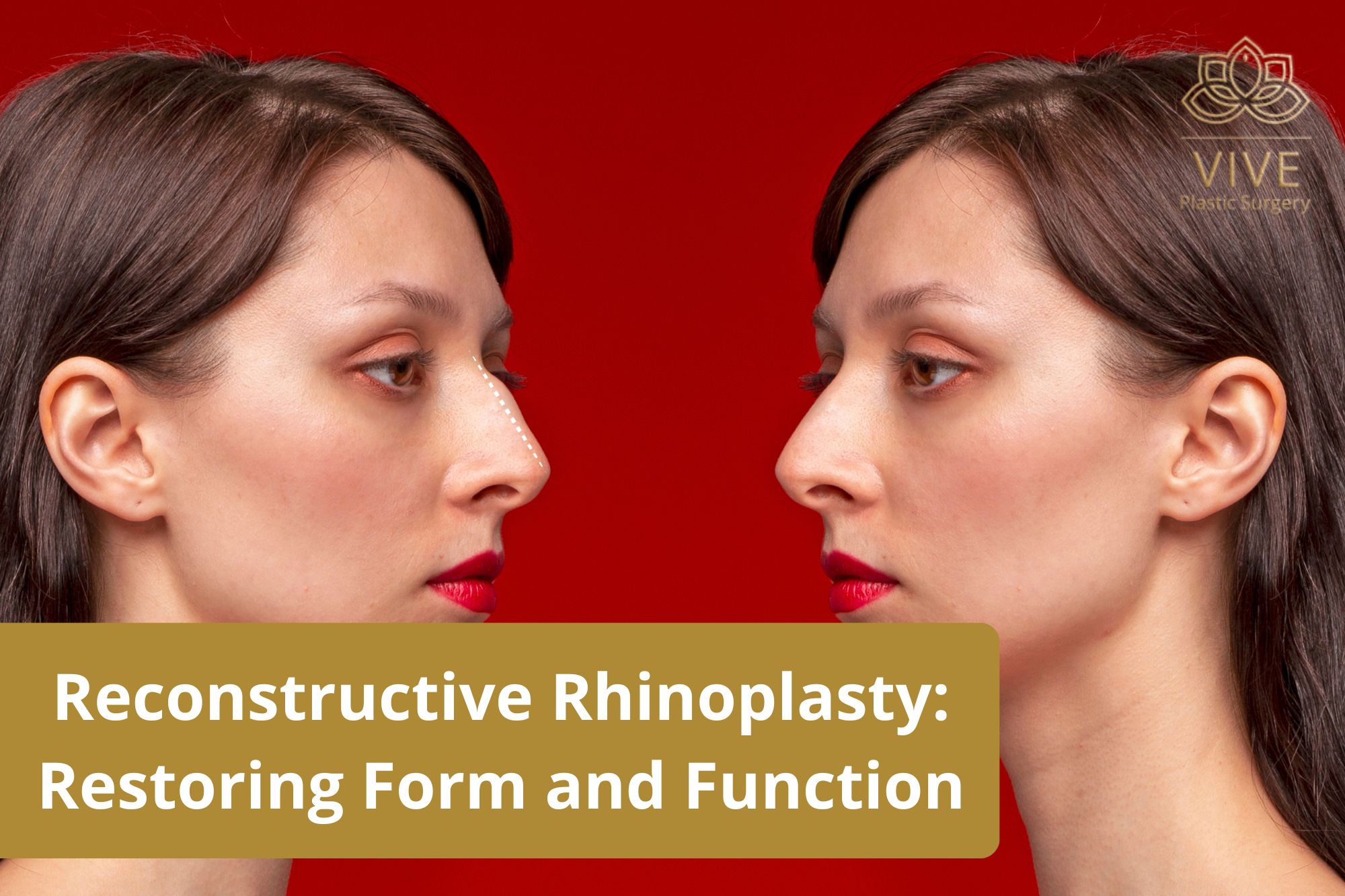 Reconstructive Rhinoplasty: Restoring Form and Function